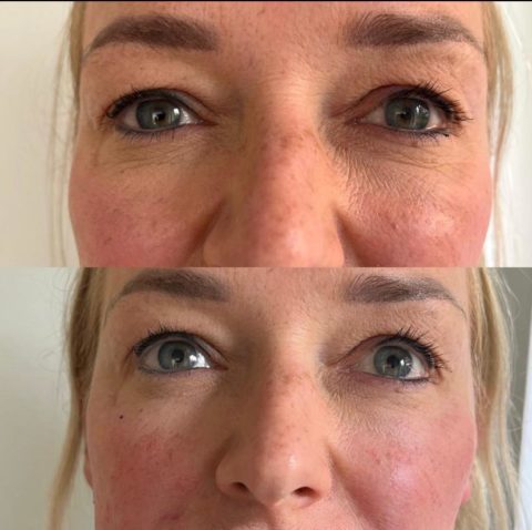 SuneKos Performa | Avenue MediSpa, Havant, Emsworth, Westbourne