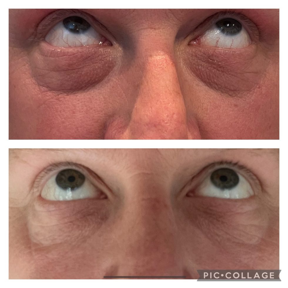 SuneKos Performa | Avenue MediSpa, Havant, Emsworth, Westbourne