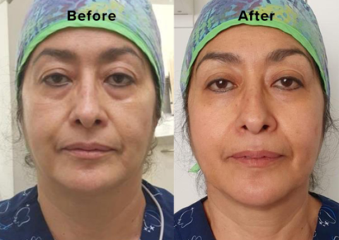 SuneKos Performa | Avenue MediSpa, Havant, Emsworth, Westbourne